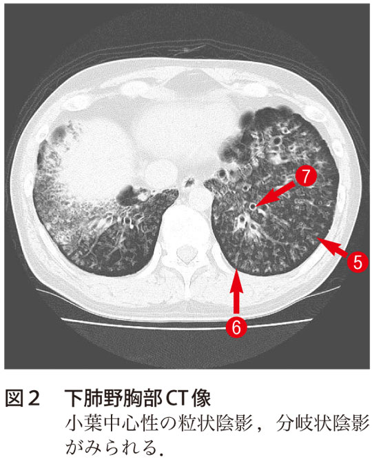 【解答・解説】喀痰，咳嗽，息切れを主訴とした30歳代男性｜実践！画像診断Q&A｜羊土社：レジデントノート ｜実践！画像診断Q&A｜羊土社 ...